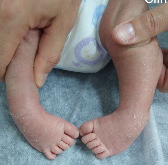 Pie bot – Tratamiento con yesos de pie bot con metodo Ponseti🦶