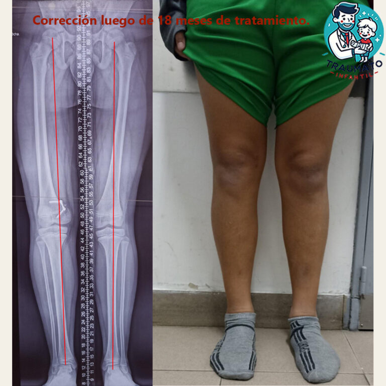 Genu valgo infantil: diagnóstico y tratamiento en pediatría 🦵